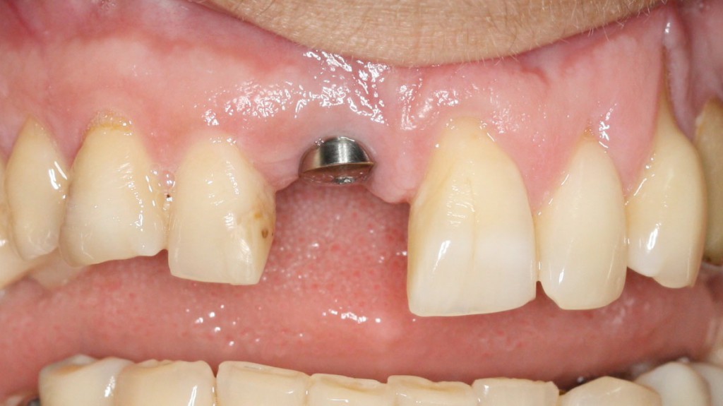 Colocación de un implante unitario en un incisivo - Clínica dental ...